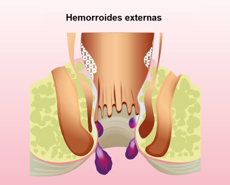 ¿Qué son las hemorroides internas y externas? – Nikzon®
